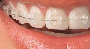 Frenillos invisibles, Dr Cristian Vargas Aragonés, Ortodoncia | Dent ...